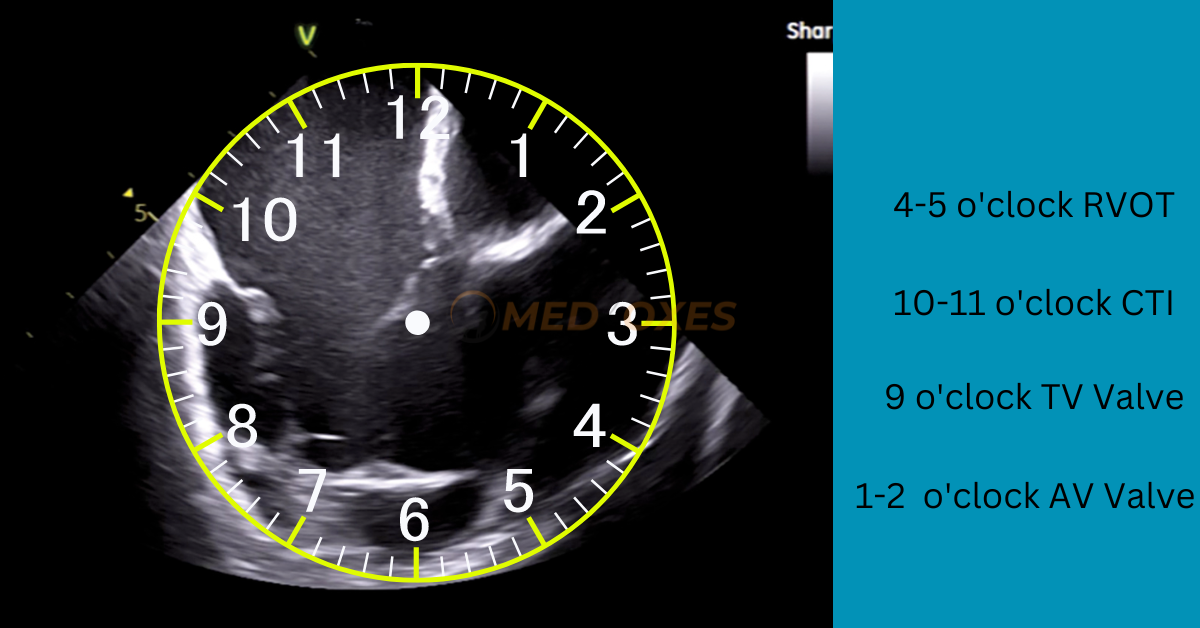 Intracardiac Echocardiography Catheter Manipulation Technique – MEDFOXES