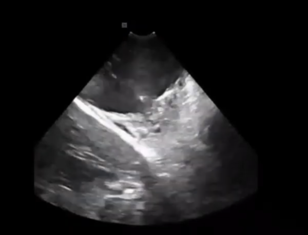 Non-Fluoroscopy ICE Catheter Manipulation – MEDFOXES
