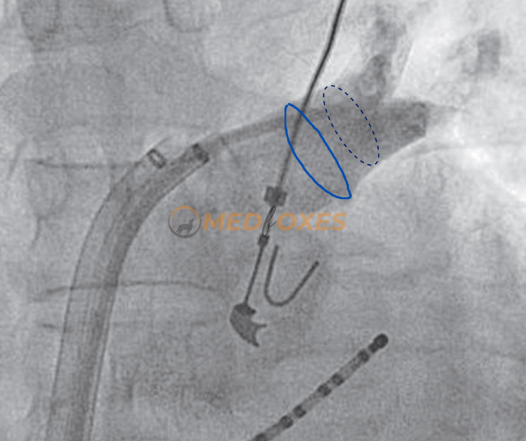 Atrial Fibrillation, Pulmonary Vein Mapping Techniques – MEDFOXES