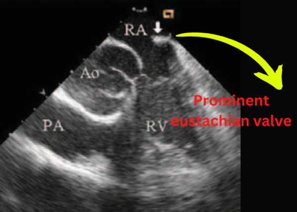 Cardiac Structures in Intracardiac Echocardiography - MEDFOXES