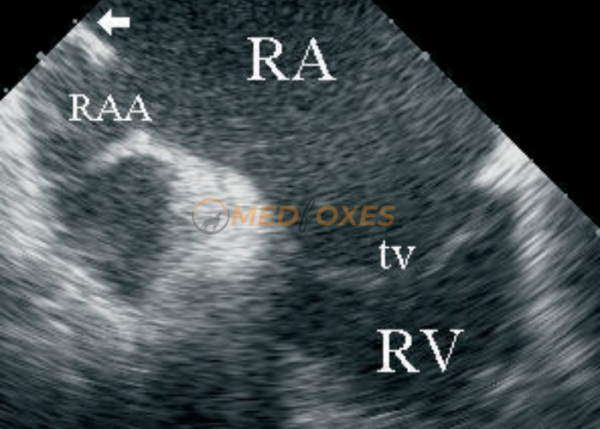 Cardiac Structures in Intracardiac Echocardiography - MEDFOXES