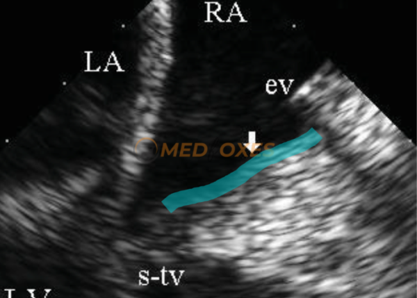 Cardiac Structures in Intracardiac Echocardiography - MEDFOXES