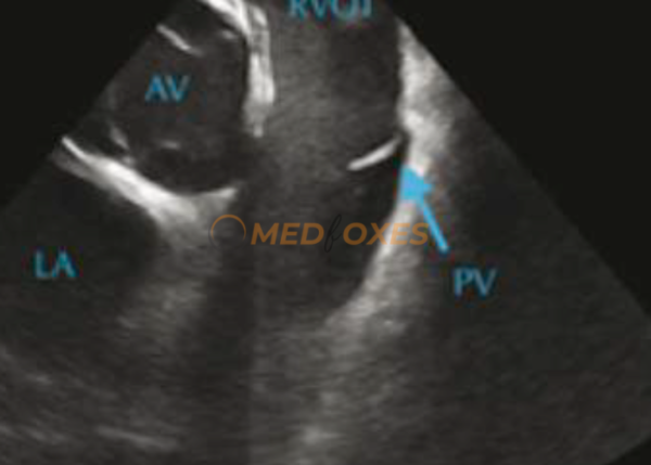 Cardiac Structures in Intracardiac Echocardiography - MEDFOXES