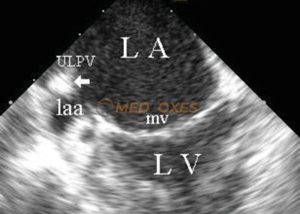 Cardiac Structures in Intracardiac Echocardiography - MEDFOXES